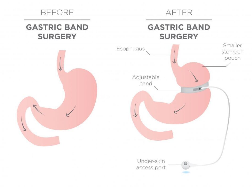Understanding the types of Bariatric Surgery | Medika Life : Digestive ...